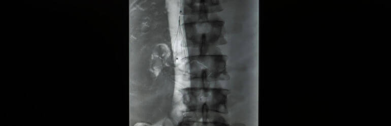 IVC Filter Attorney Greensboro, NC | Ward Black Law